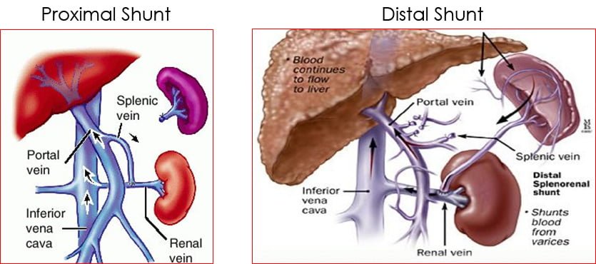 PORTAL HYPERTENSION - Dr AvinashTank, is a super-specialist (MCh ...