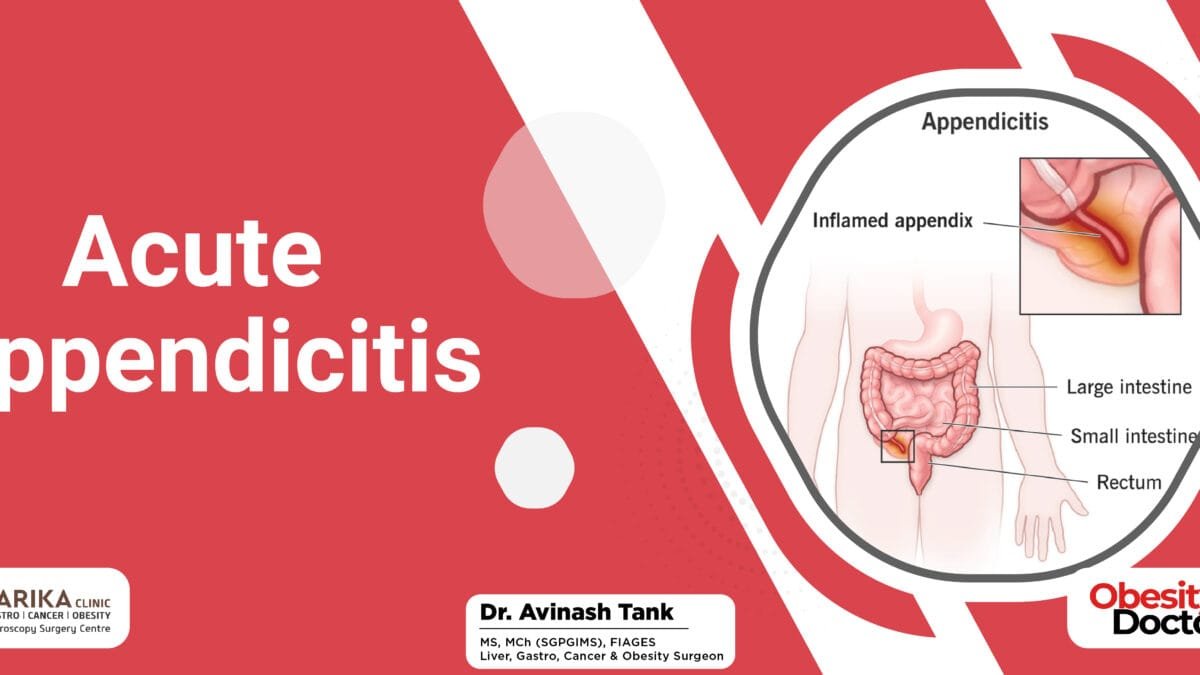 Appendicitis Pain Appendicitis: Symptoms And Causes HealthXchange