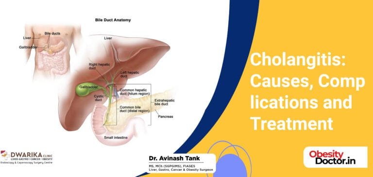 Cholangitis: Causes, Complications and Treatment - Dr AvinashTank, is a ...