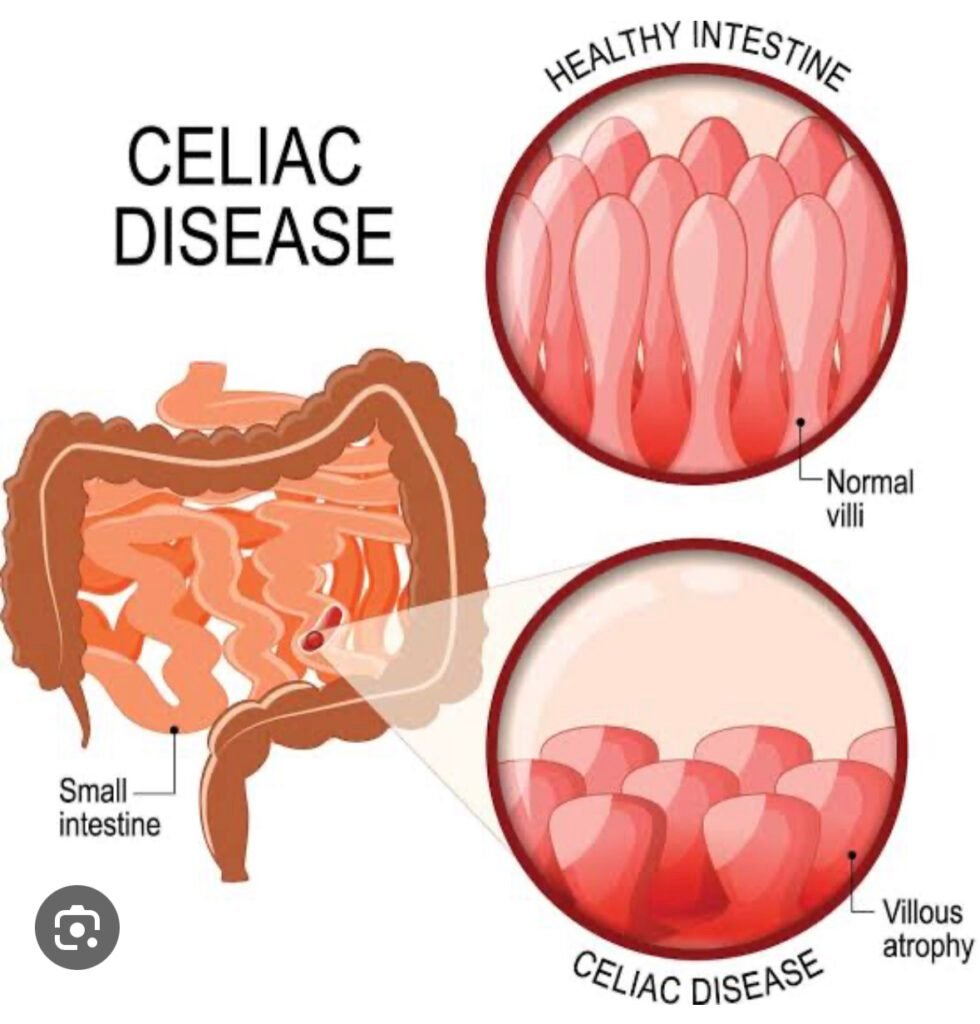 Celiac Disease: Causes, Diagnosis, and Treatment - Dr AvinashTank, is a ...