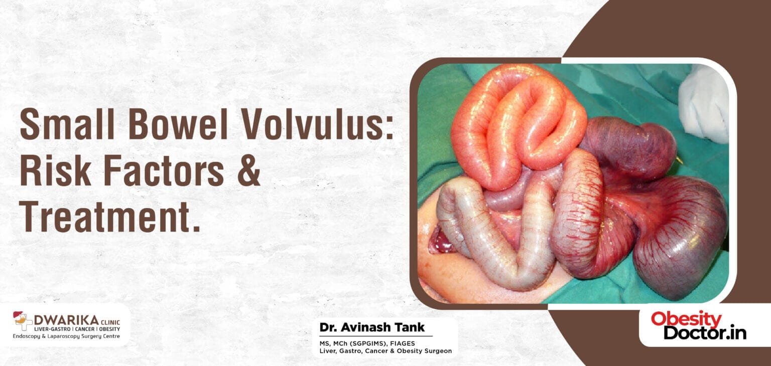 Small Bowel Volvulus: Risk Factors & Treatment. - Dr AvinashTank, is a ...