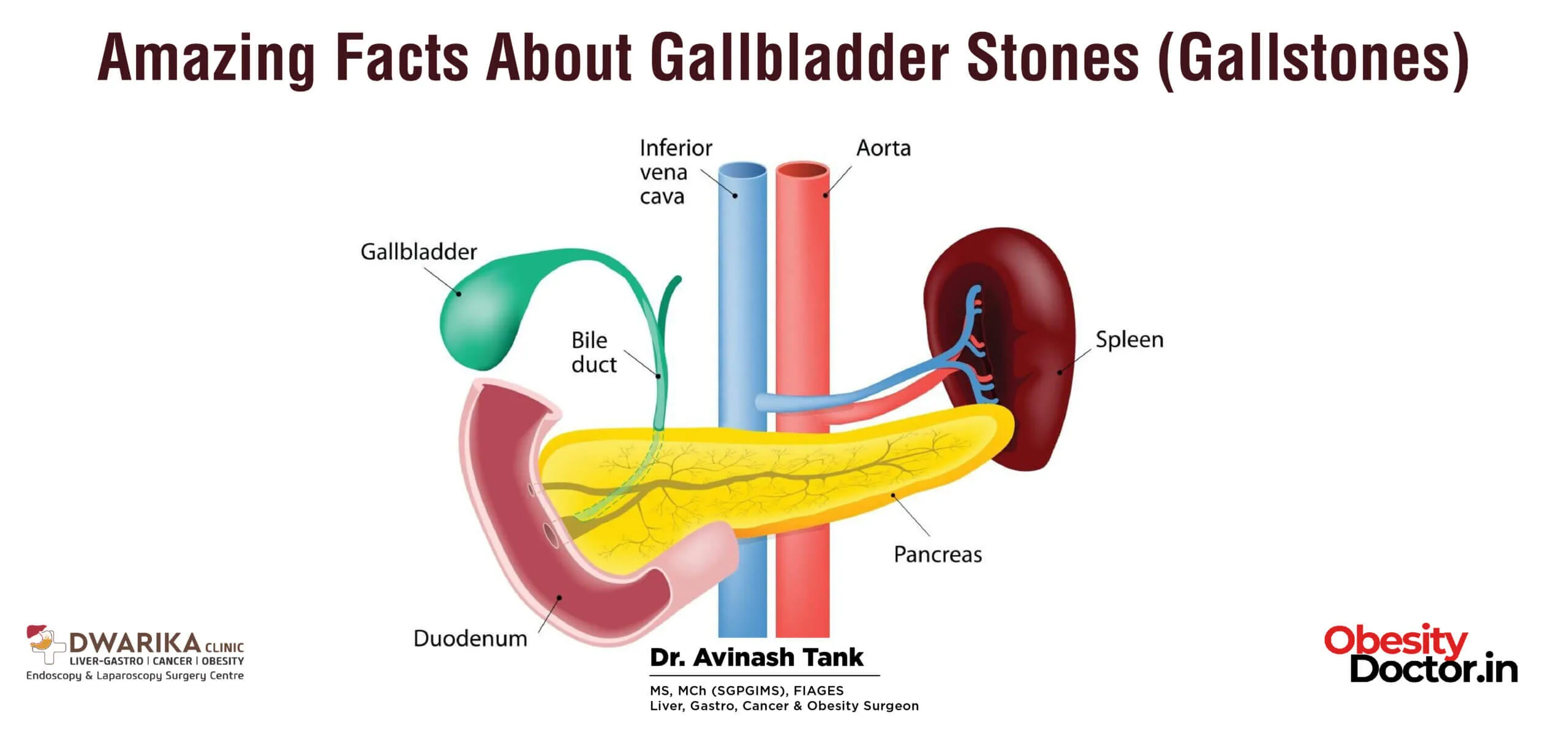 Gall Stone Model Labeled Gallstones Treatment London, UK