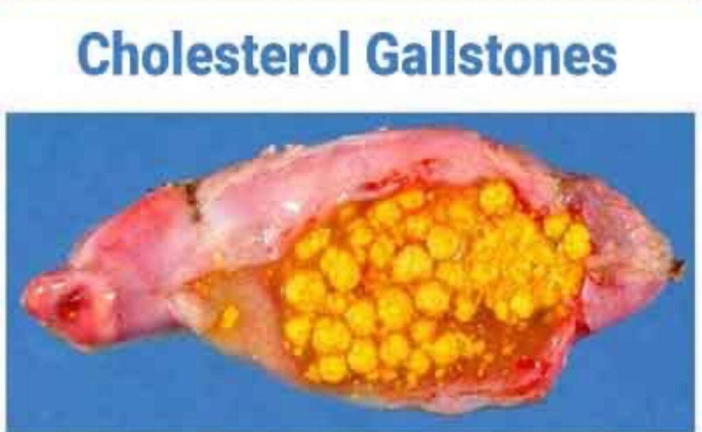 Gallbladder Stones (Gallstones): Types, Risk Factors & Diet for ...