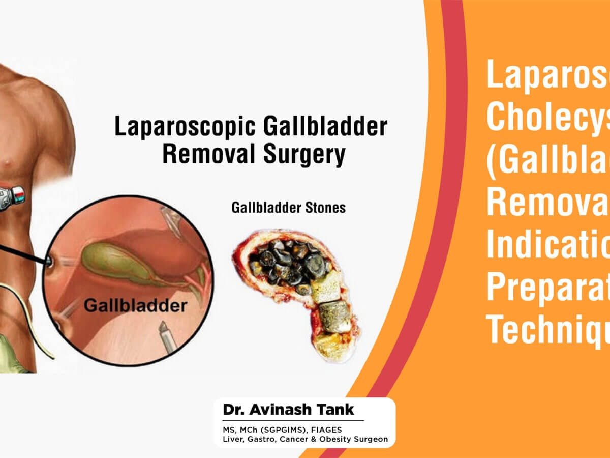 Laparoscopic Cholecystectomy Steps Cholecystectomy Open Versus
