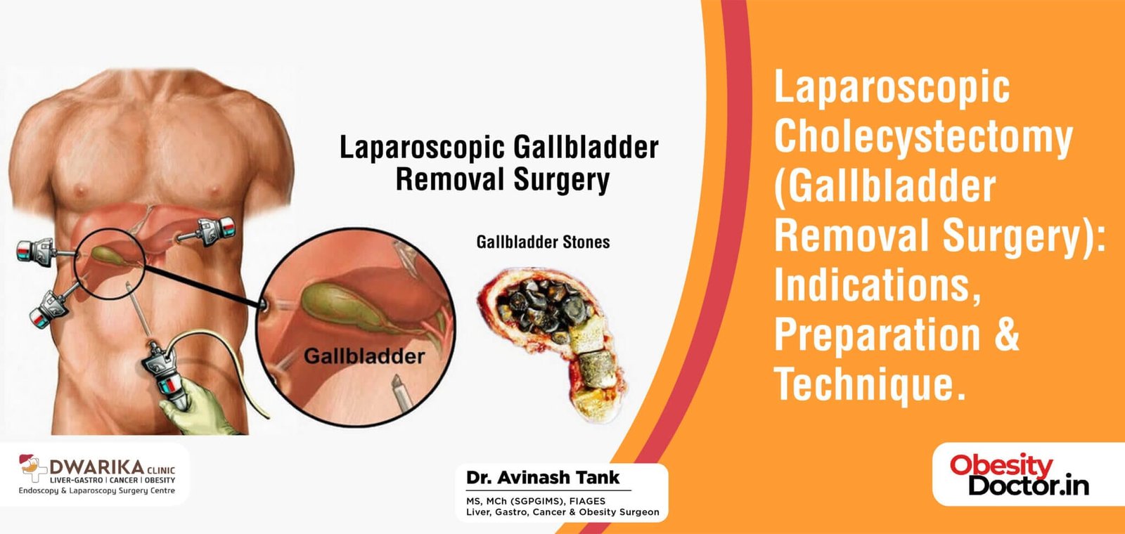 Laparoscopic Cholecystectomy ( Gallbladder Removal Surgery): Indications, Preparation ...