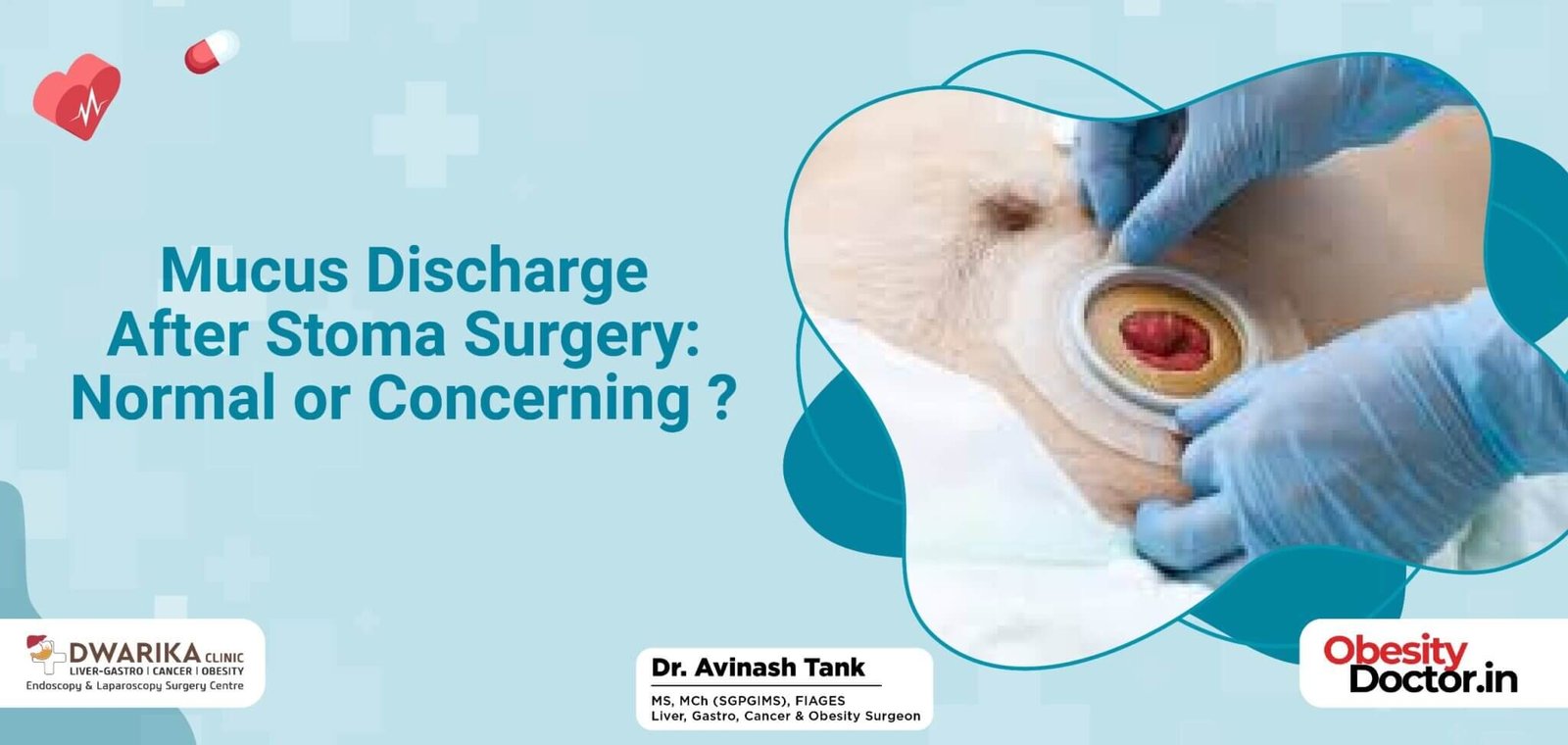 Mucus Discharge After Stoma Surgery: Normal or Concerning? - Dr ...
