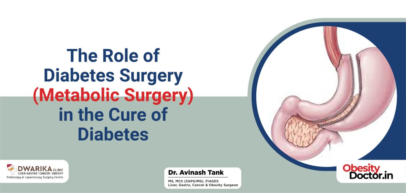 The Role of Diabetes Surgery (Metabolic Surgery) in the Cure of ...
